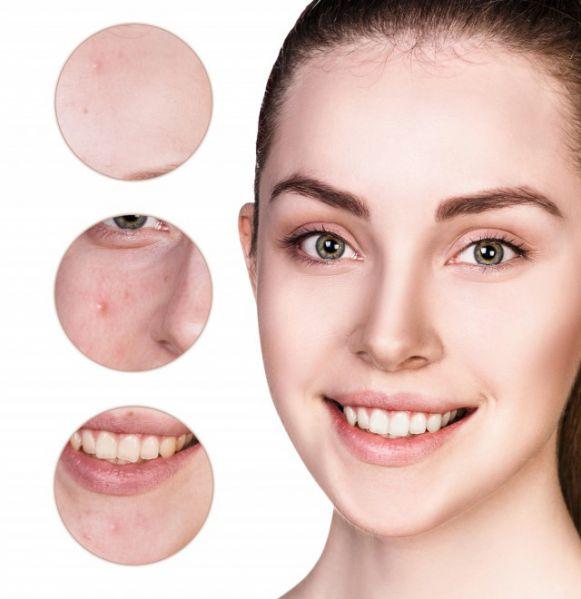 5 Useful Tips For Acne Treatment | LookHealthyStore